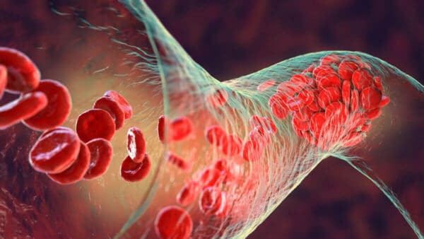 Blood Clot Treatment Options - World Thrombosis Day