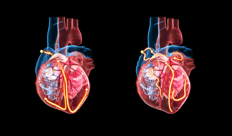 What is Thrombosis? - World Thrombosis Day
